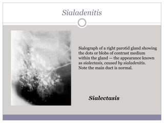 salivary gland radiologic imaging doc.pptx