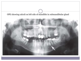 salivary gland radiologic imaging doc.pptx