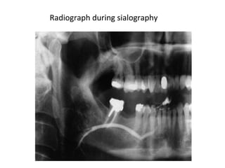 Salivary gland imaging and sialochemistry (radiological and ...