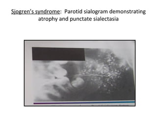 Salivary gland imaging and sialochemistry (radiological and ...