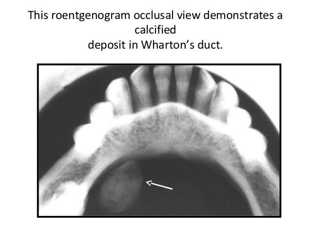 Salivary Gland Stone Cheek Swollen Cheeks From Tooth, Glands And Jaw,