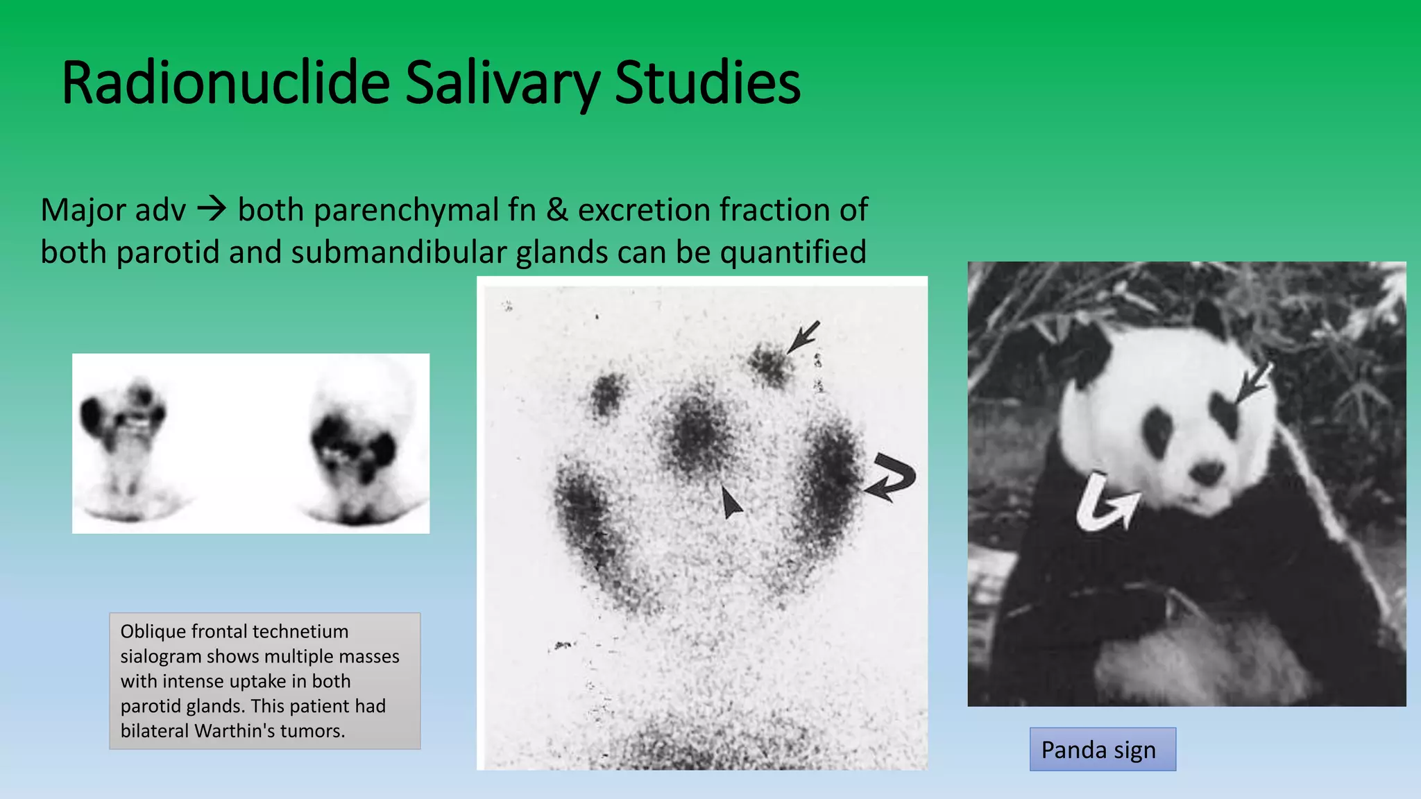 Salivary gland imaging radiology ppt | PPTX