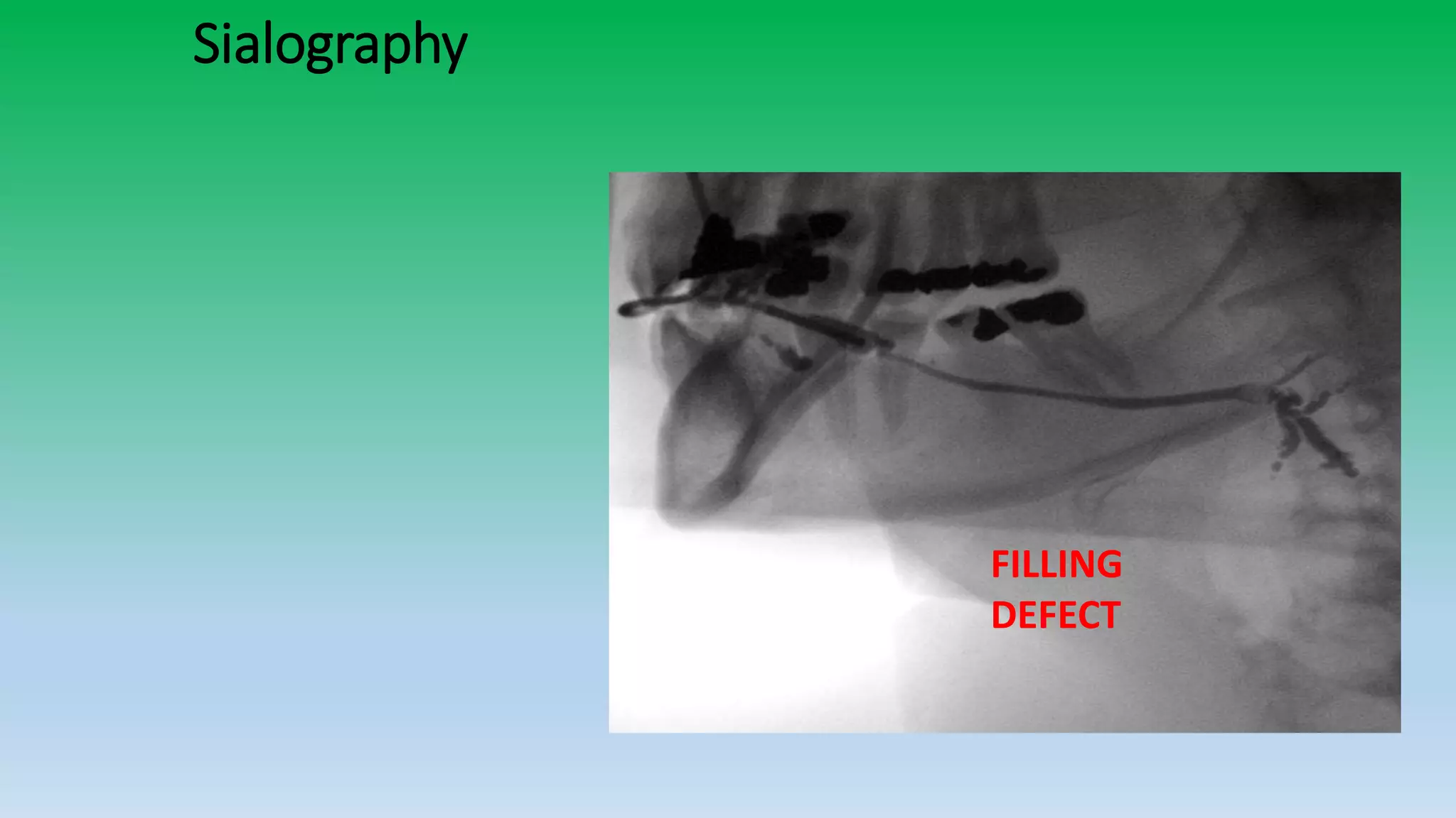 Salivary gland imaging radiology ppt | PPTX