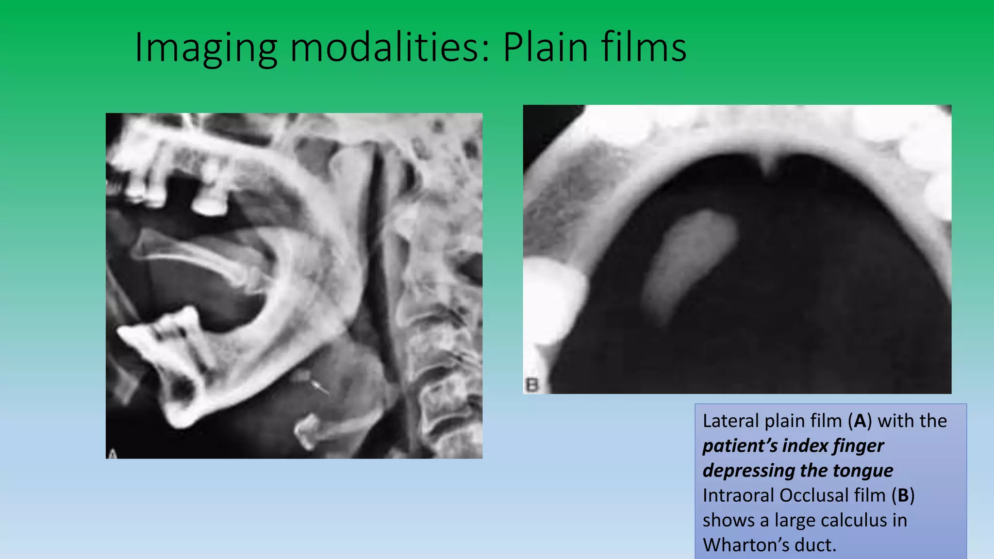 Salivary gland imaging radiology ppt | PPTX