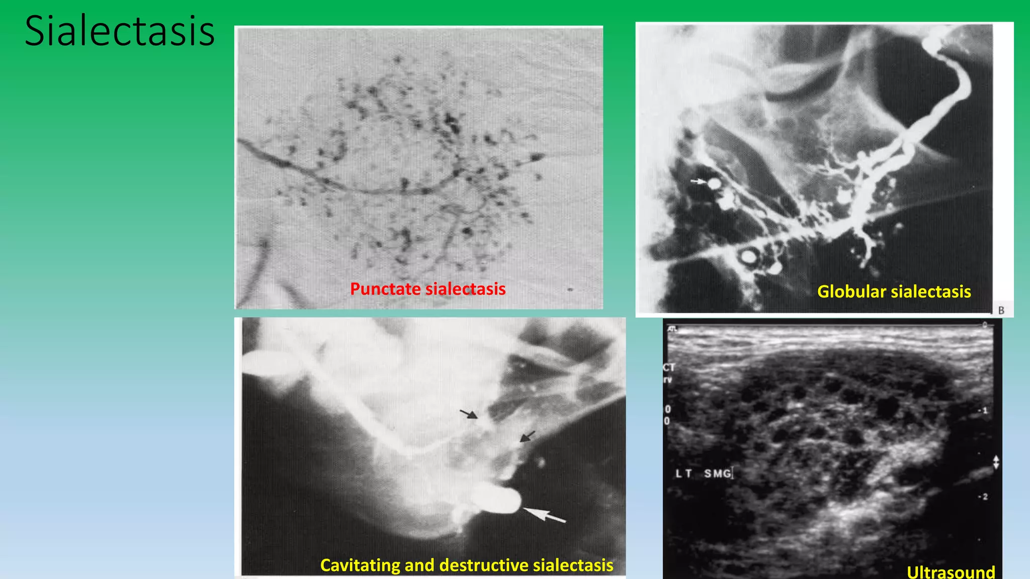 Salivary gland imaging radiology ppt | PPTX