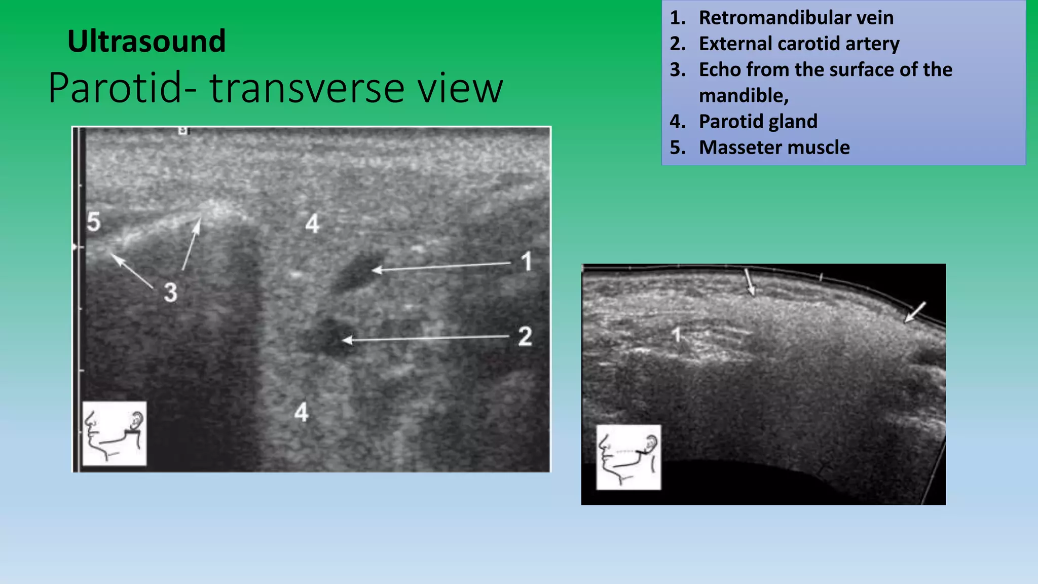 Parotid Gland Anatomy Ultrasound