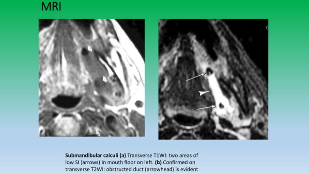 Salivary gland imaging radiology ppt | PPTX