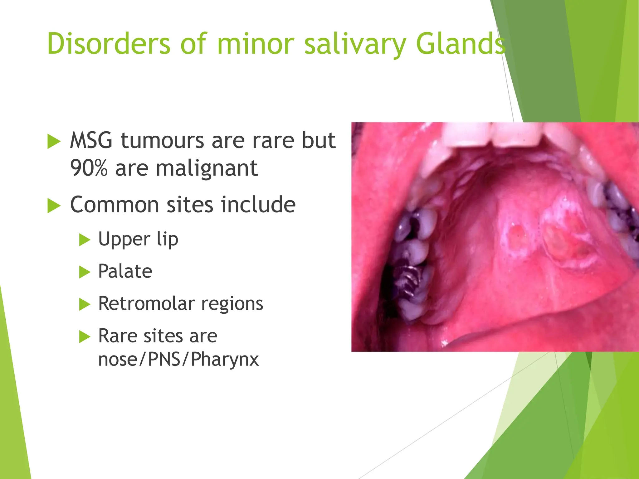 salivary gland investigation and management.ppt