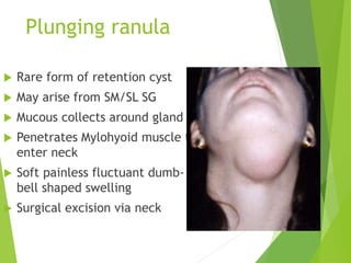 salivary gland investigation and management.ppt