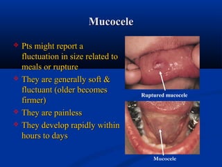 Salivary gland pathology | PPT