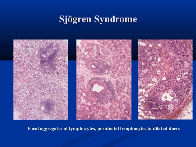 Salivary gland pathology