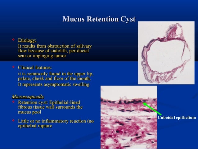 Salivary gland pathology