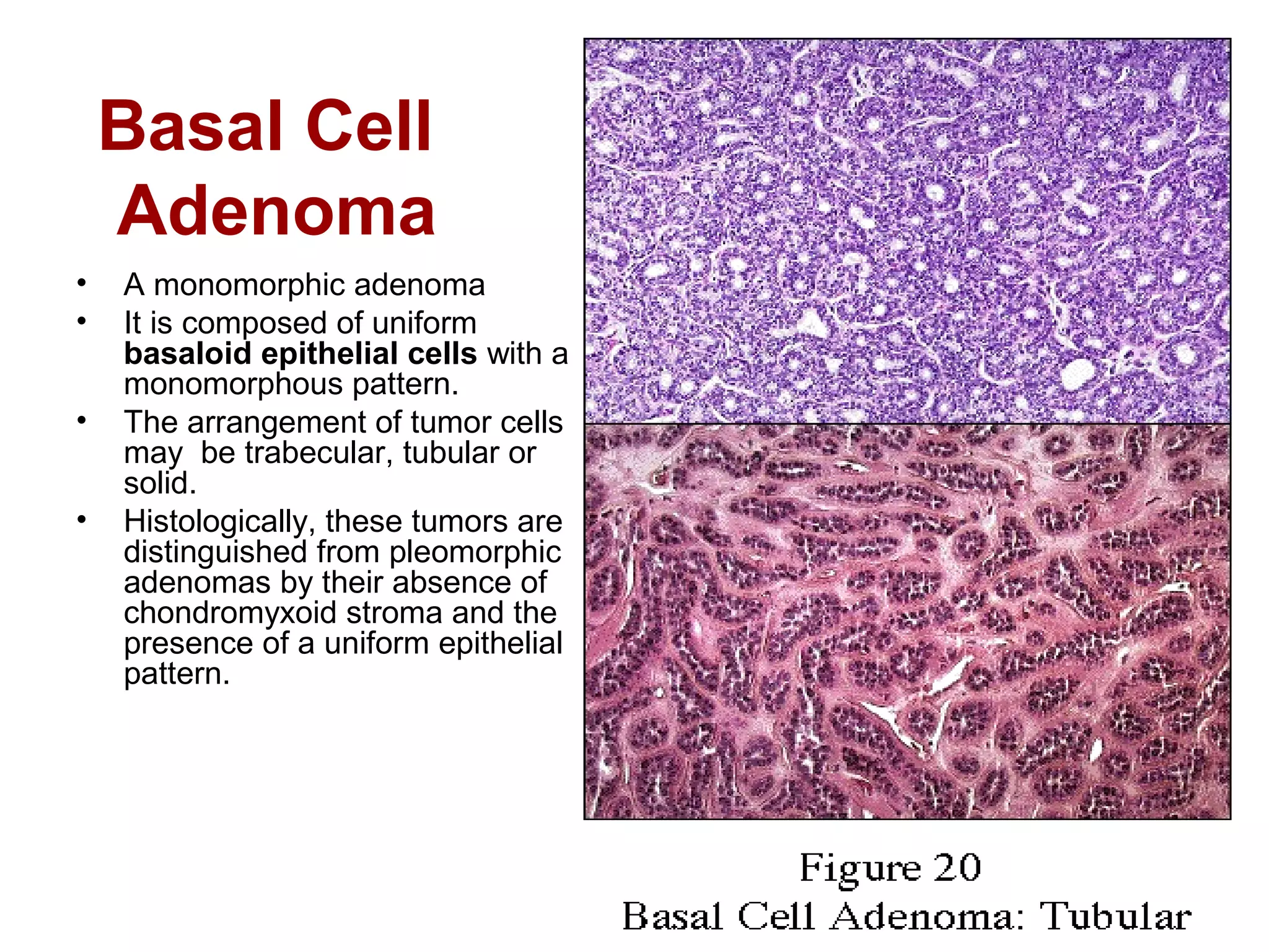 Salivary gland pathology | PPT