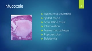 Salivary gland pathology 2 | PPTX