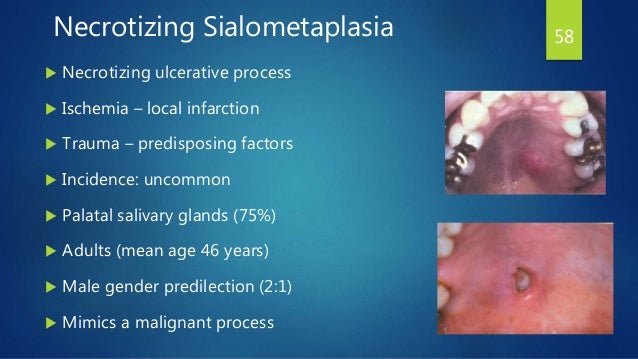 Salivary gland pathology 2