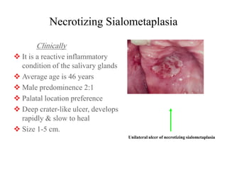 Necrotizing Sialometaplasia Histology