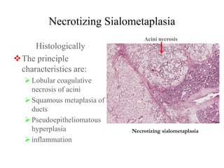 Necrotizing Sialometaplasia Histology