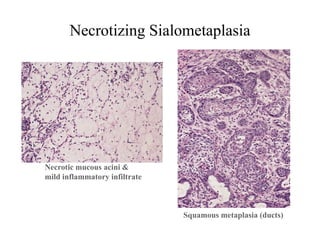 Necrotizing Sialometaplasia Histology
