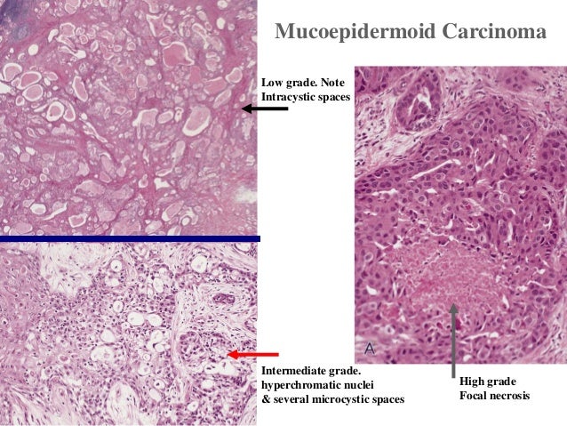 Salivary gland pathoology 1