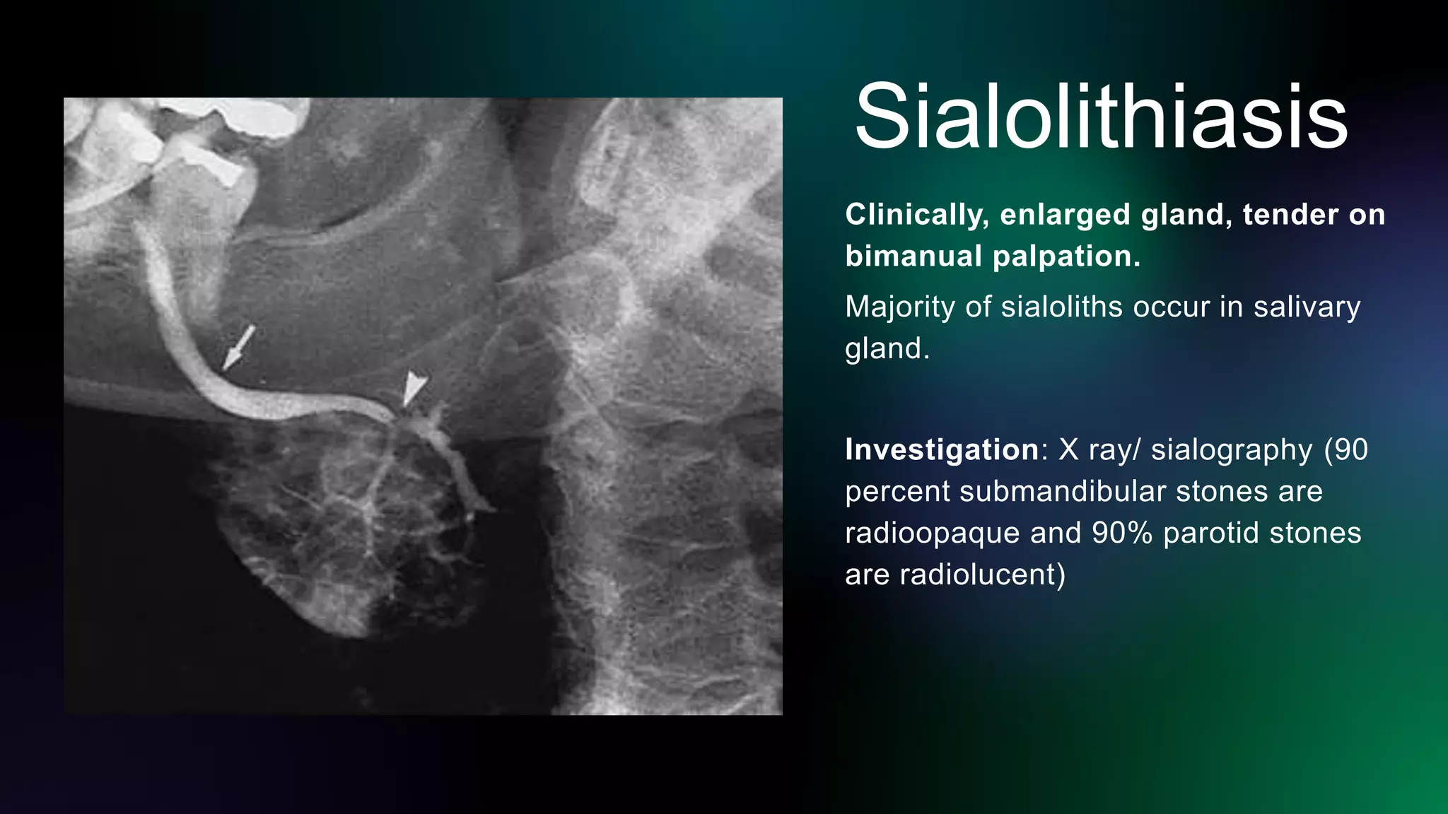 disorders of Salivary gland ppt | PPTX