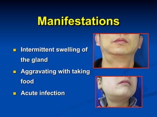 Submandibular Gland Swelling