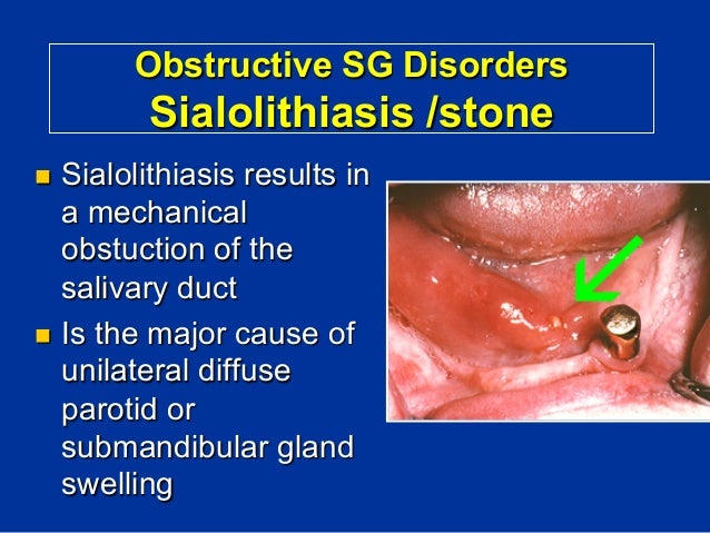 Salivary glands diseases