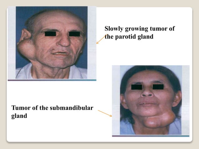 Salivary gland Tumors | PPTX