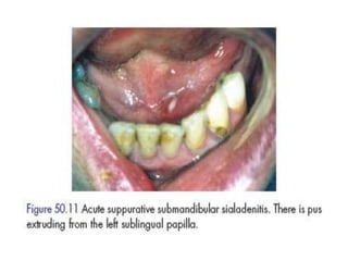 Sialadenitis Sublingual