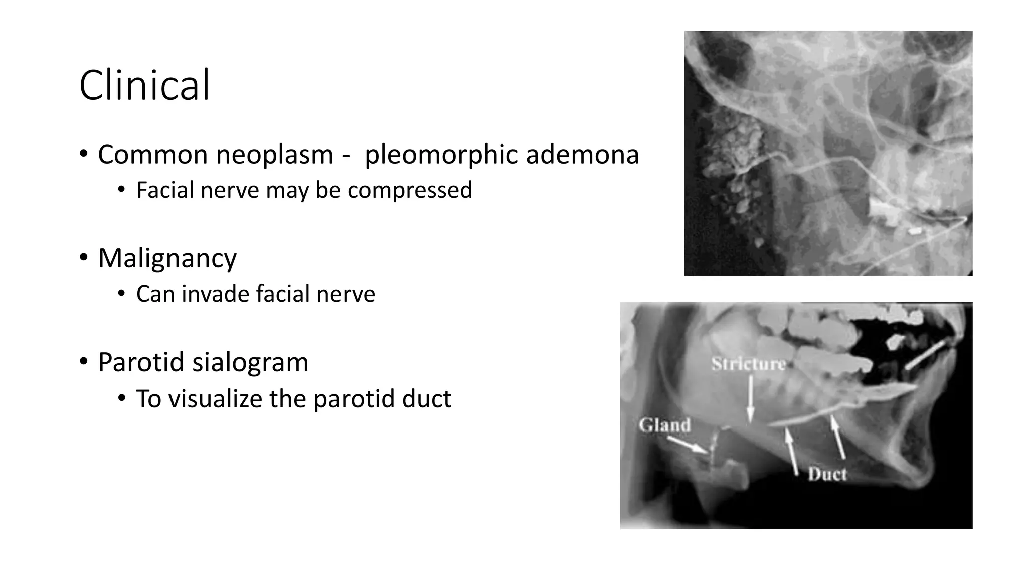 Parotid Salivary glands .pptx