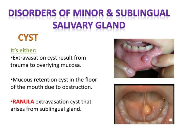 Salivary Glands Anatomy Clinical Features And Diseases Management Ppt