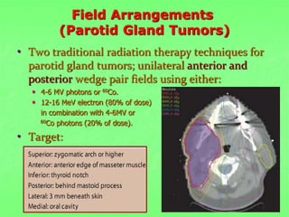 Salivary glands cancer | PDF
