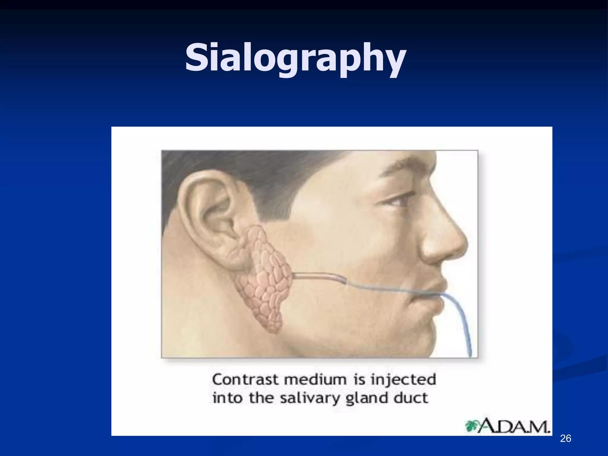 Salivary glands disorders i | PDF