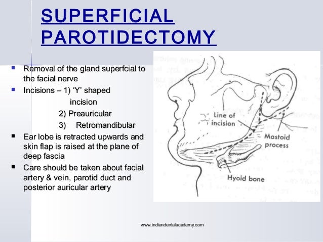 Parotid Salivary Gland Removal Superficial Parotidectomy