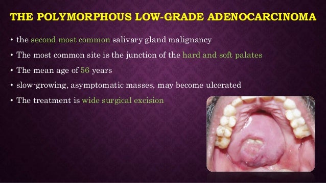 Salivary glands tumors (Dentistry)