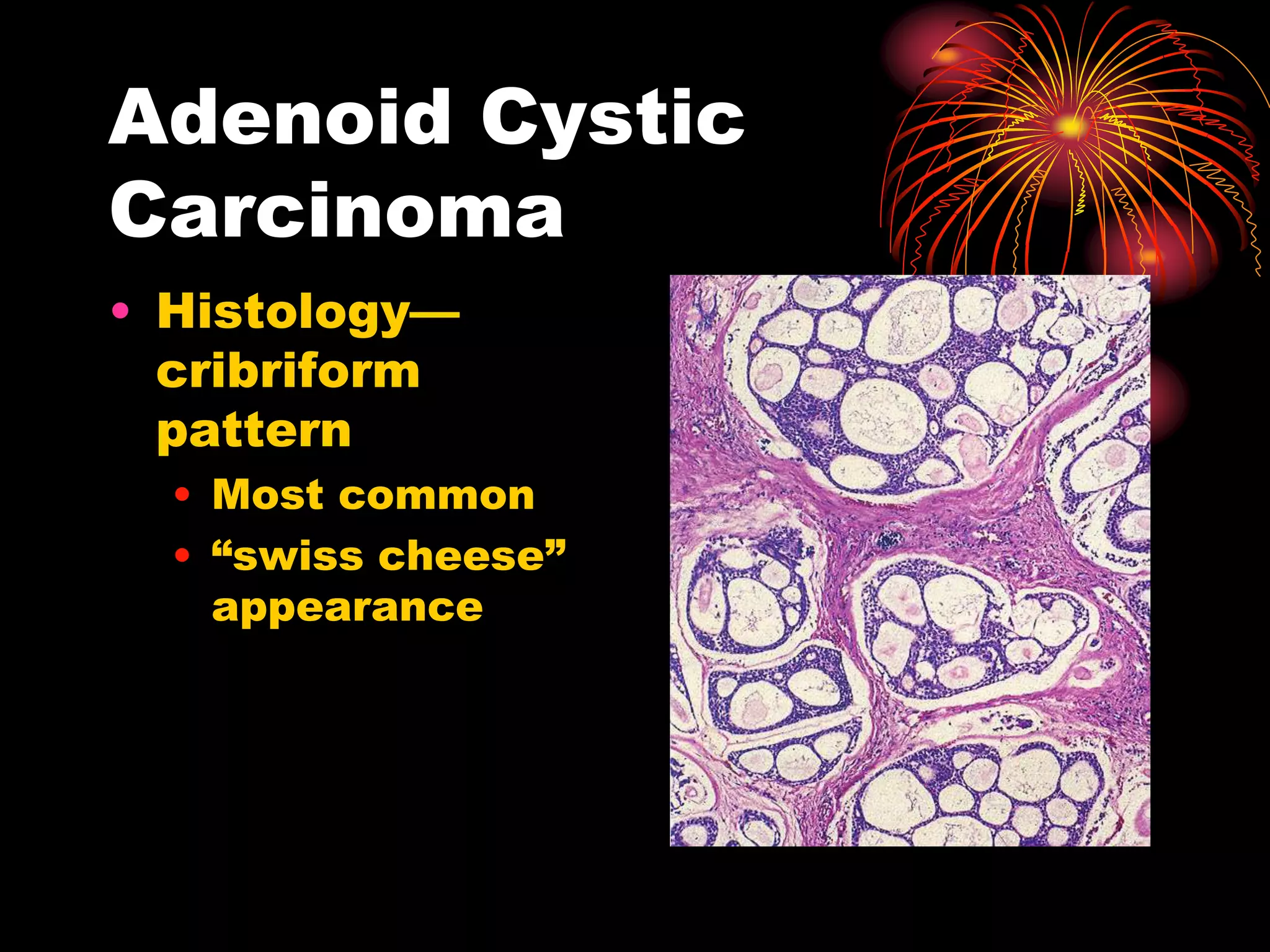 Salivary Glands Tumors Newppt