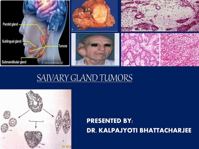 Salivary gland tumors | PPTX