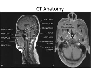 Nasopharyngeal Carcinoma | PPT