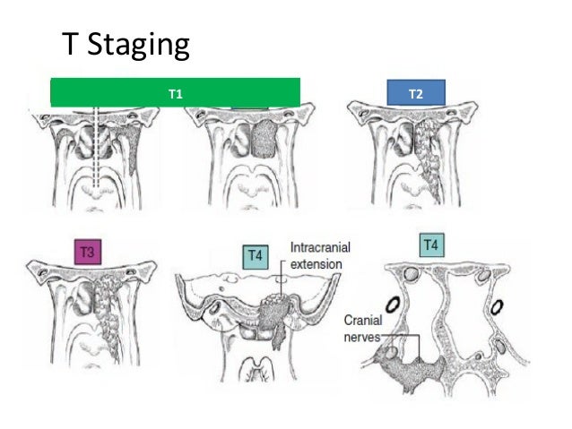 Nasopharyngeal Carcinoma