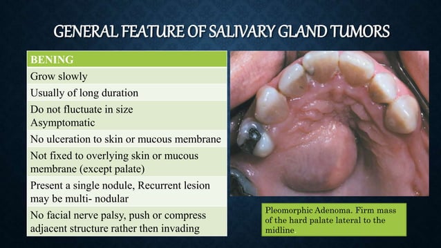 Salivary gland tumors classification | PPTX | Ear, Nose and Throat Conditions | Diseases and ...