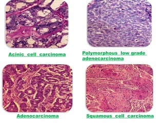 Salivary gland tumors final p pt.pptx
