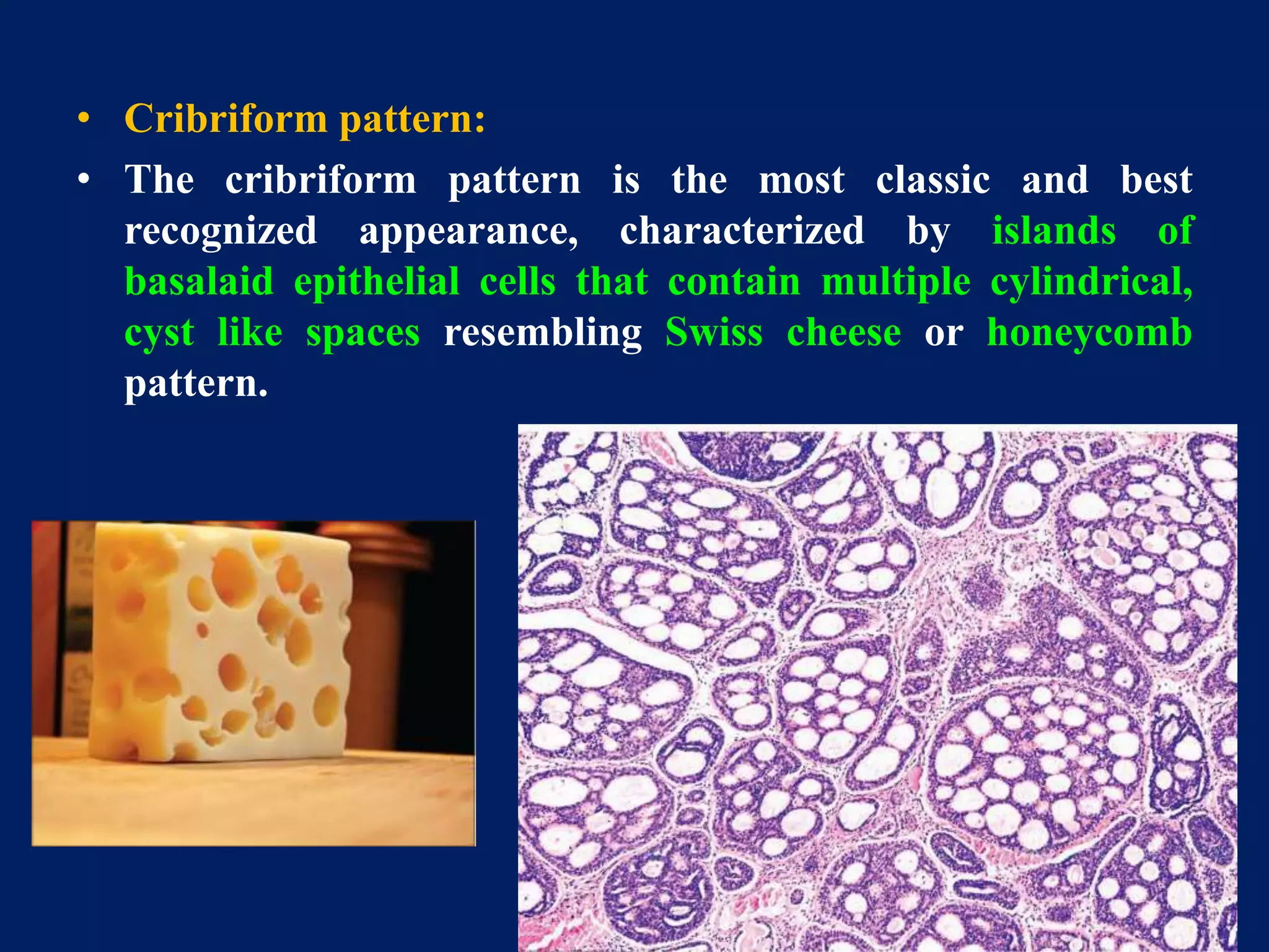 Salivary gland tumors | PPTX