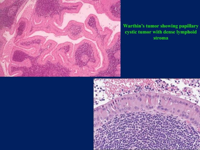 Salivary gland tumors | PPTX | Ear, Nose and Throat Conditions | Diseases and Conditions