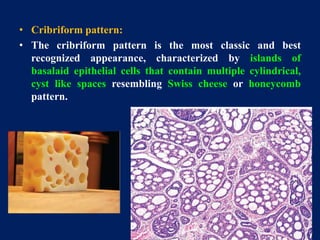 Salivary gland tumors | PPTX