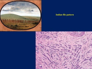 Salivary gland tumors | PPTX