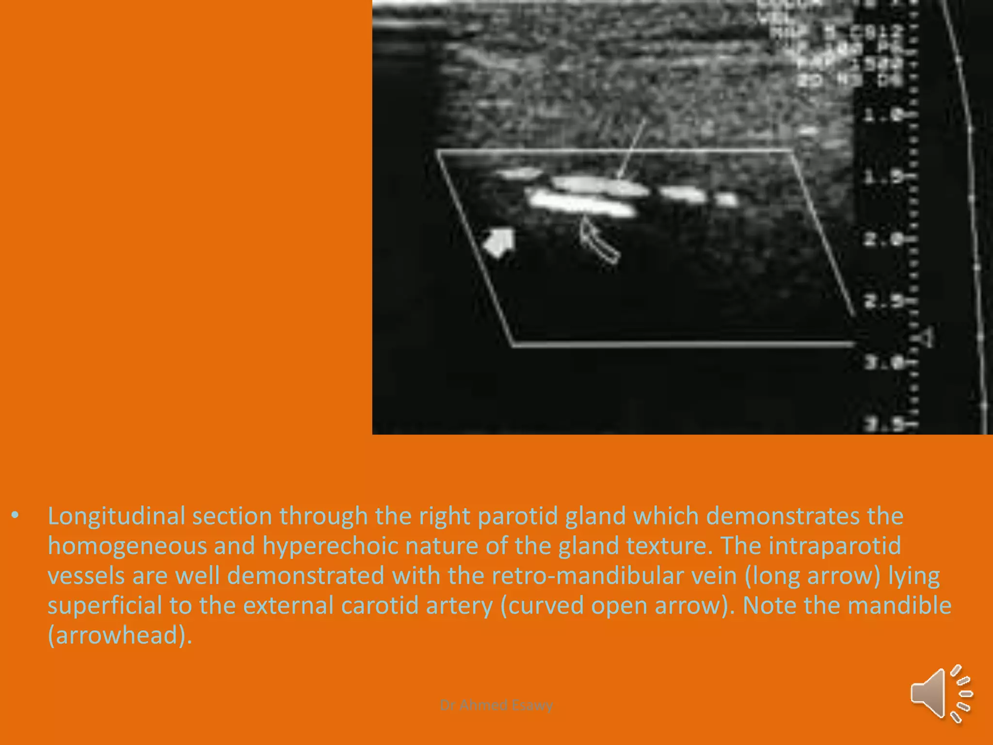 Dr Ahmed Esawy Salivary gland ultrasound | PDF