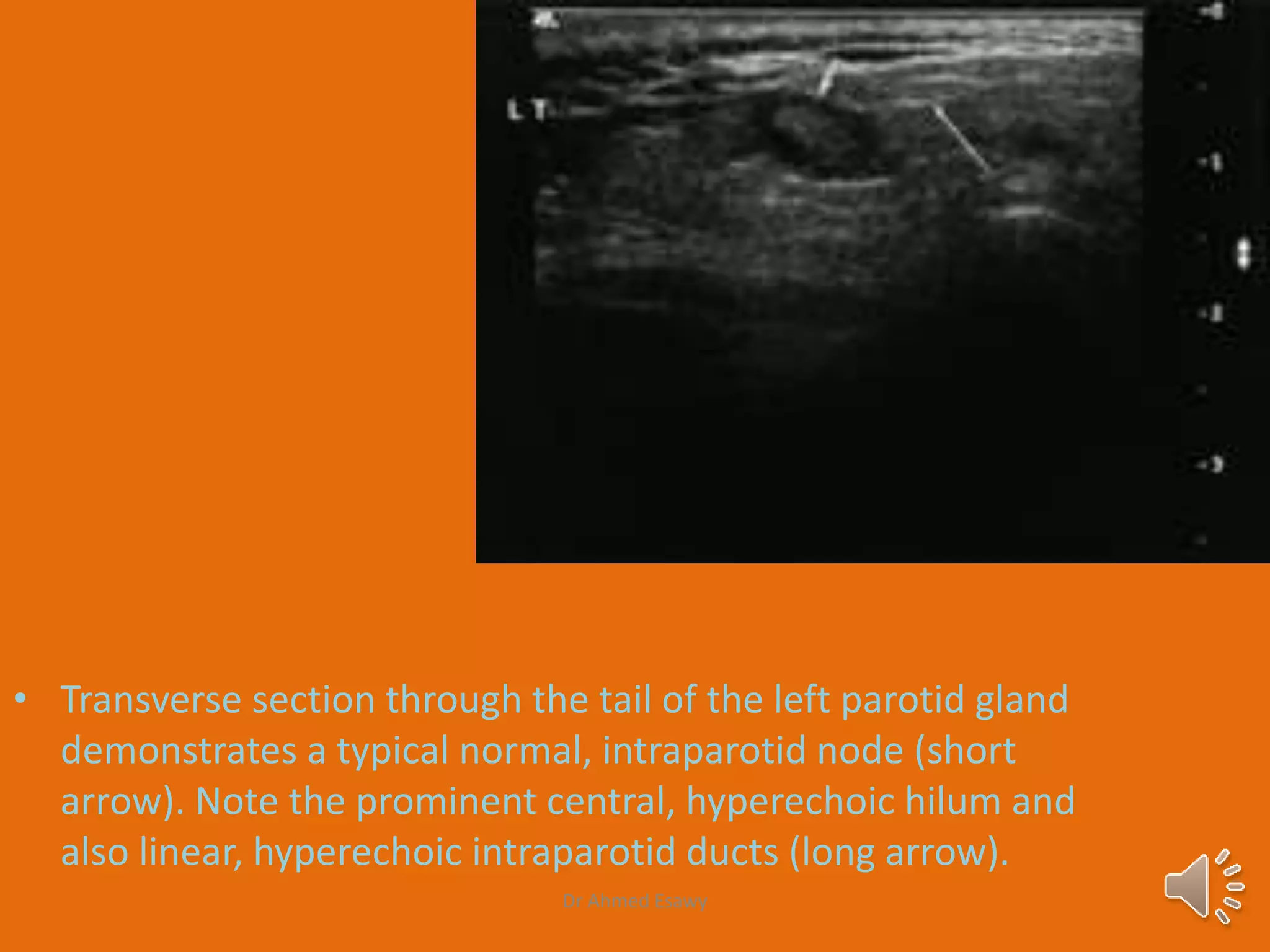 Dr Ahmed Esawy Salivary gland ultrasound | PDF