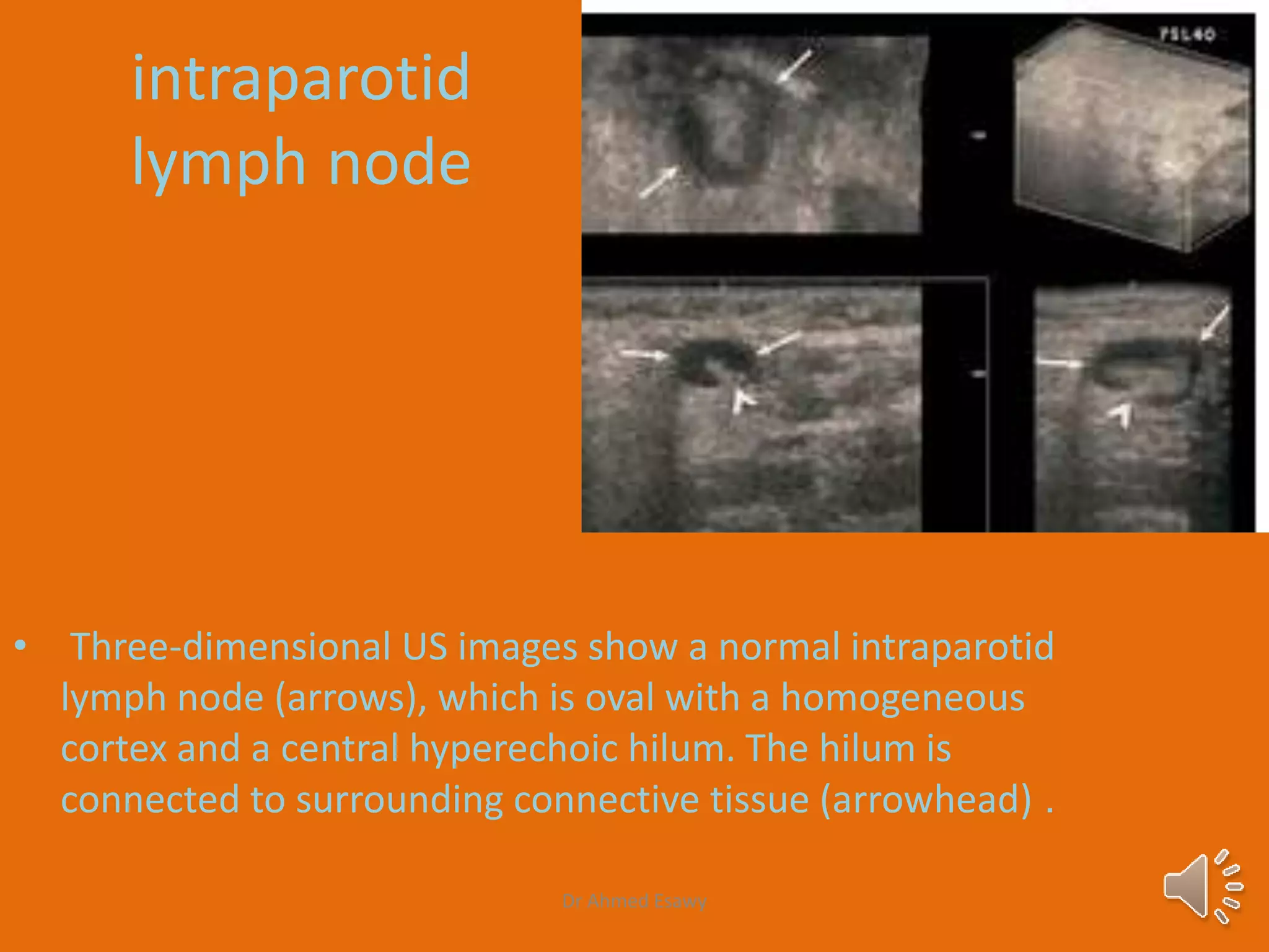 Dr Ahmed Esawy Salivary gland ultrasound | PDF