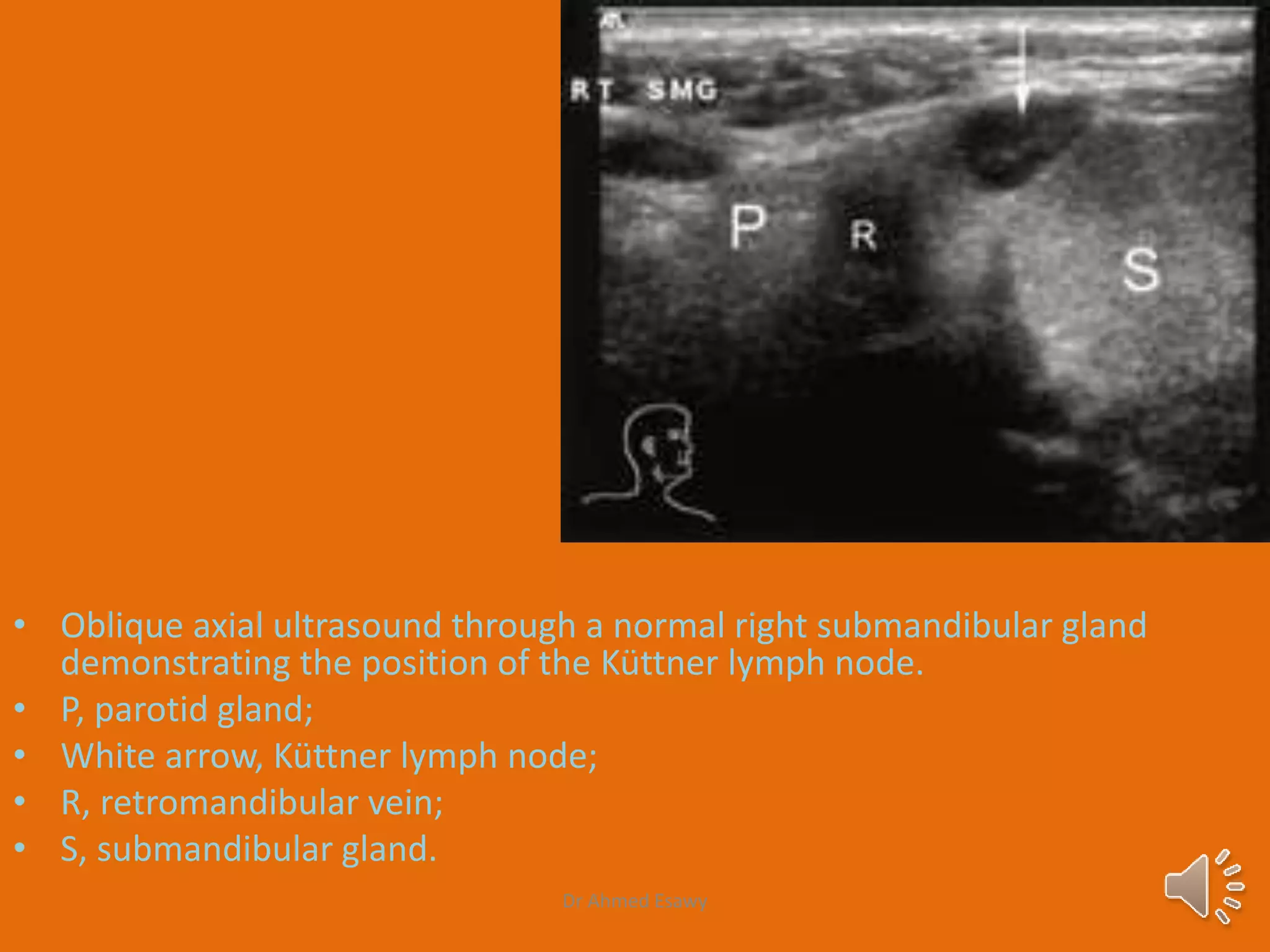 Dr Ahmed Esawy Salivary gland ultrasound | PDF