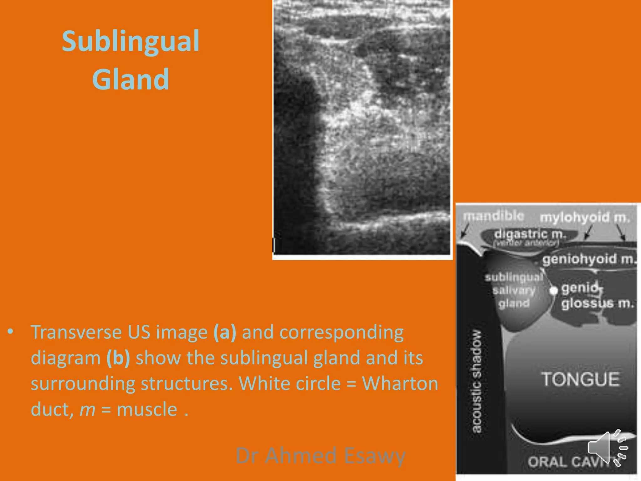 Dr Ahmed Esawy Salivary gland ultrasound | PDF
