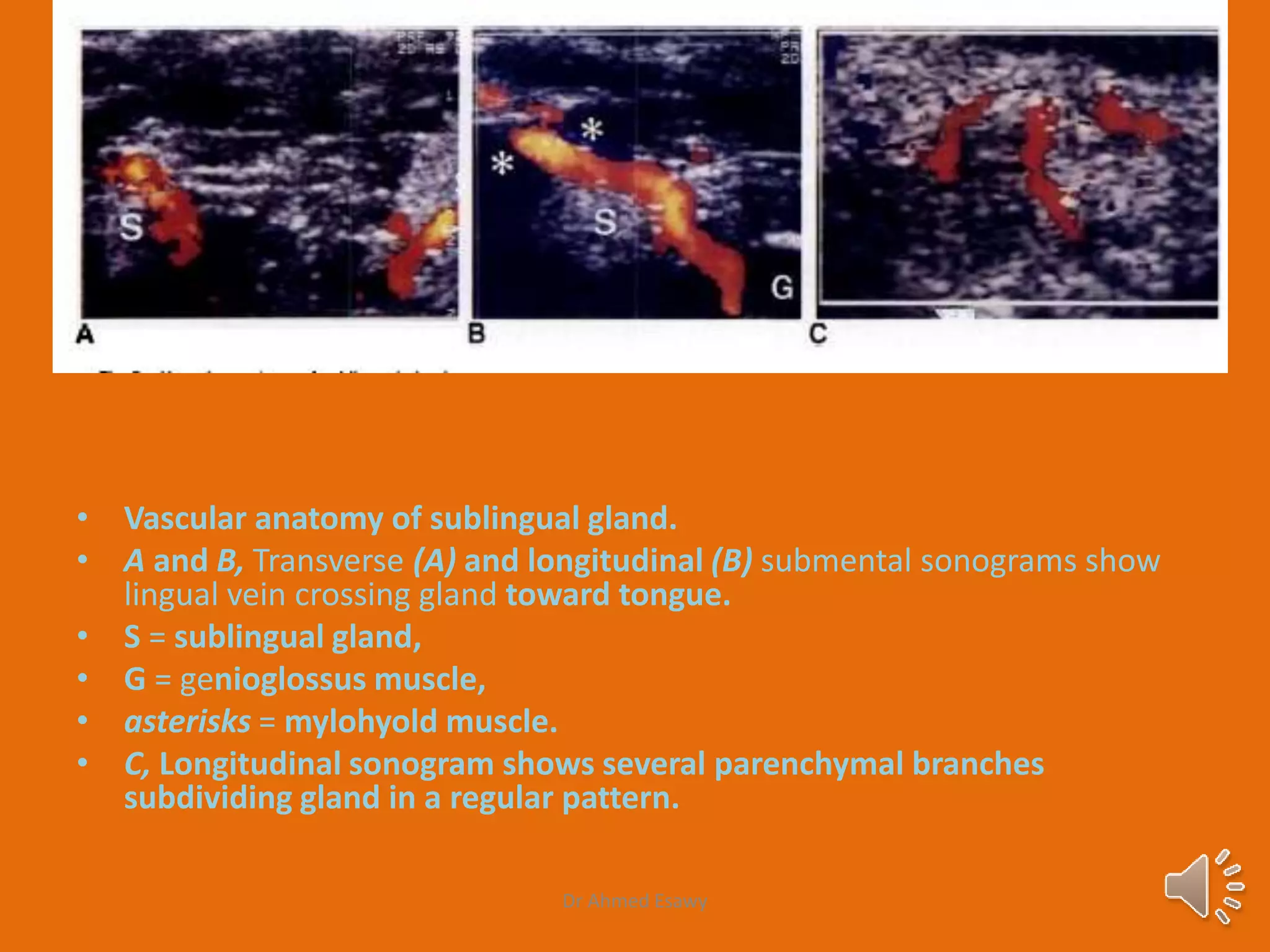 Dr Ahmed Esawy Salivary gland ultrasound | PDF